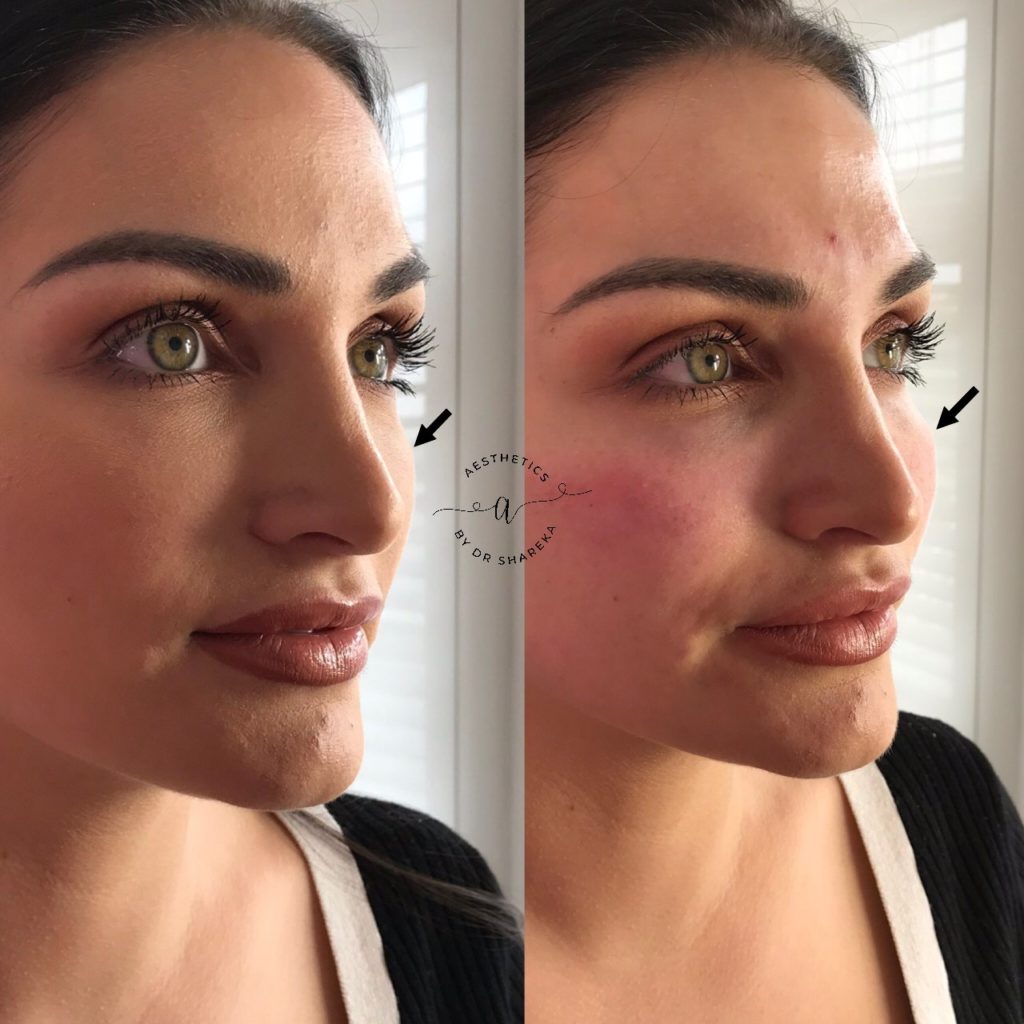 Dermal Filler Treatments for Cheeks & Midface | Aesthetics by Dr Shareka