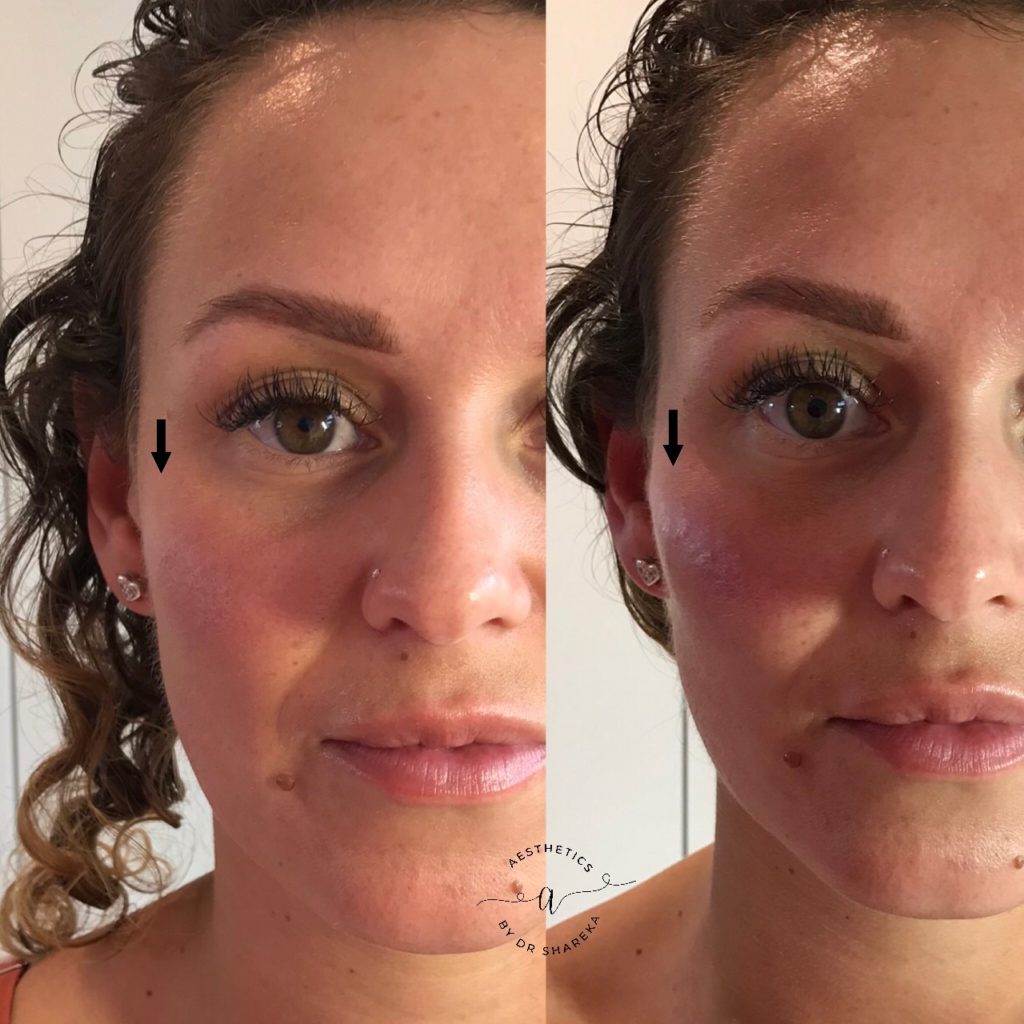 Dermal Filler Treatments for Cheeks & Midface | Aesthetics by Dr Shareka